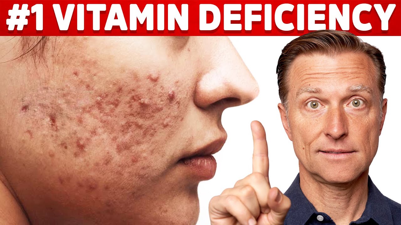 The Top Vitamin Deficiency With Acne
