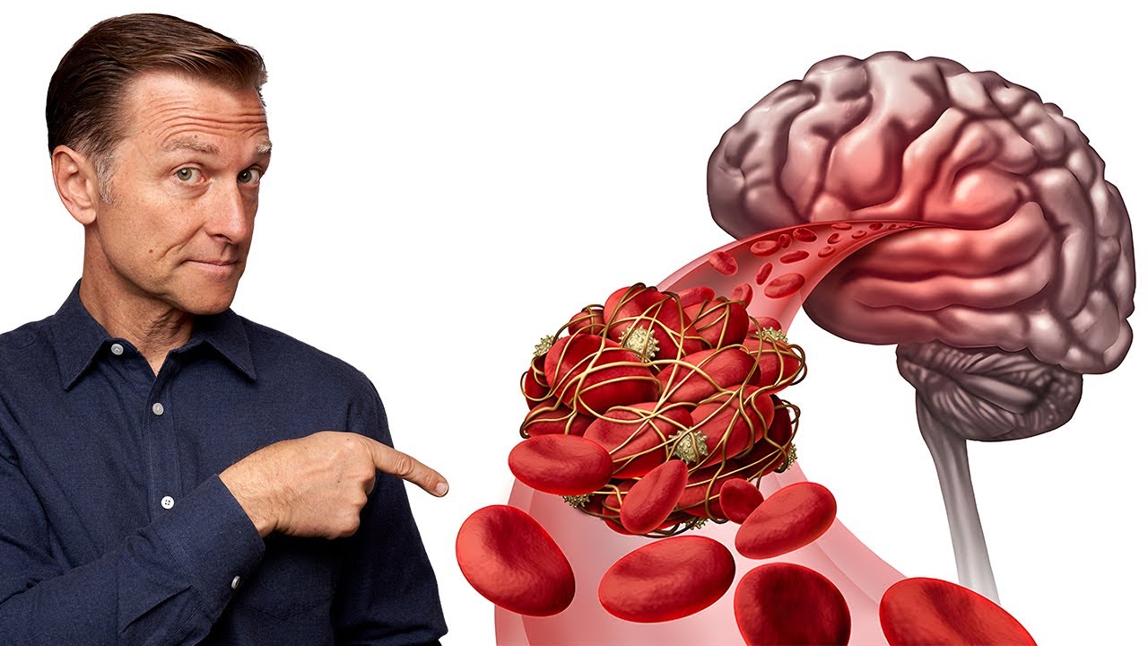 How To Predict A Silent Stroke When NO Symptoms